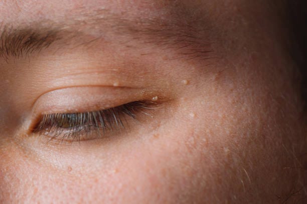 Understanding Cryotherapy vs. Ligation: Comparing Common Skin Tag ...