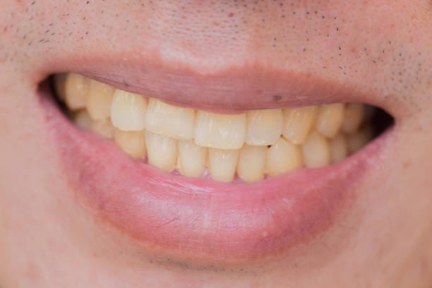 5 Ways to make your teeth bright. Yellow teeth can be a source of… | by ...