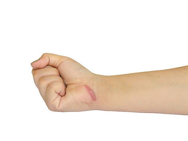 Effective Keloid Treatment Methods: A Comprehensive Guide | by ...