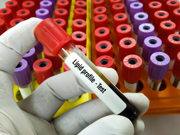 Lipid profile test - Afriglobal - Medium