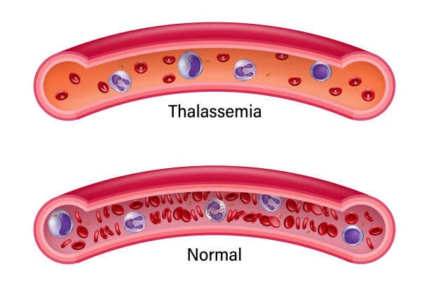 Thalassemia is a hereditary blood disorder where the body produces ...