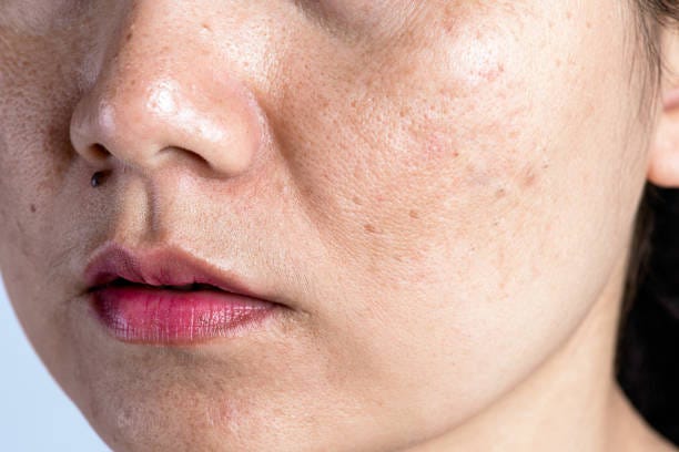 Post-Inflammatory Hyperpigmentation: A Common Side Effect of Acne and ...