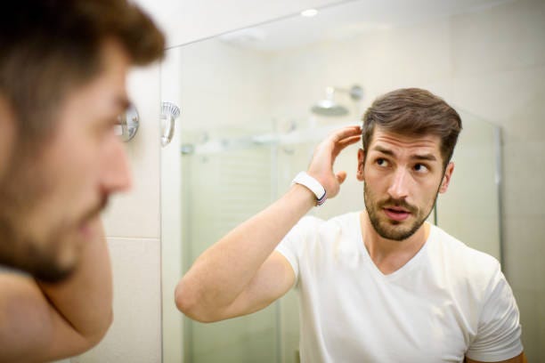 Guide to Navigating Your Male Pattern Baldness (MPB) Journey | by Tony ...