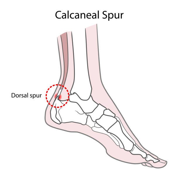 What is a heel spur? Today’s topic is: What is a heel spur? A heel spur ...