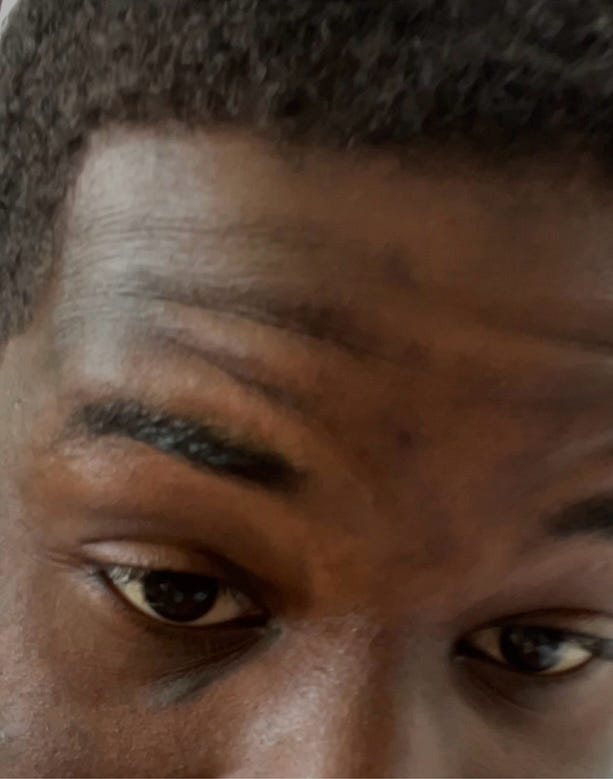 Eye got bit by a Spider I later killed | by Derick Louis | Mar, 2025 ...