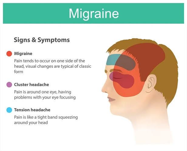Migraine disease | by Talha Shah | Nov, 2024 | Medium
