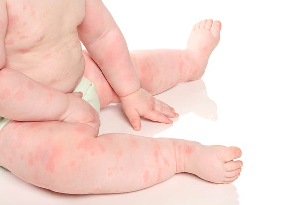 Pediatric spots and rashes. Common viral exanthemata (childhood… | by ...