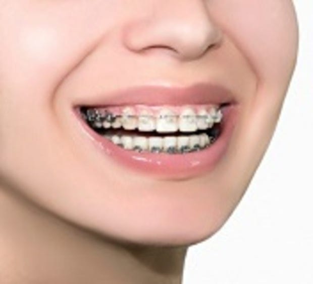 Global Dental Brackets Market:Evaluation of Opportunities, Growth ...