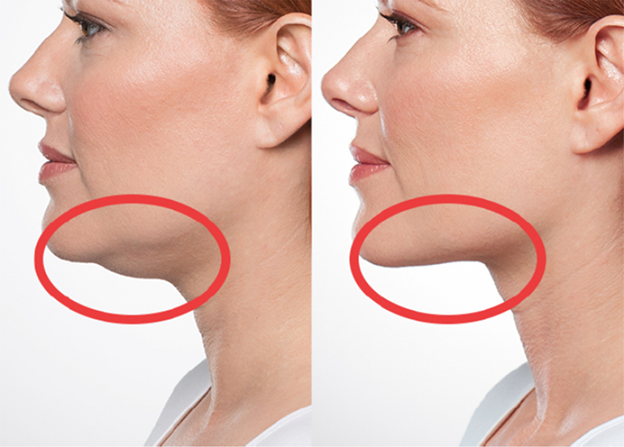 How to get rid of double chin. A roll of fatty flesh below a person’s ...