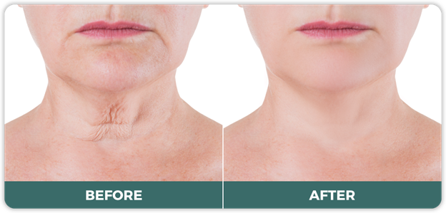 Neck Lift Surgery: Facts To Remember | by International Centre for ...