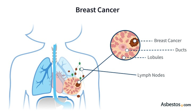 Breast Cancer Symptoms Diagram