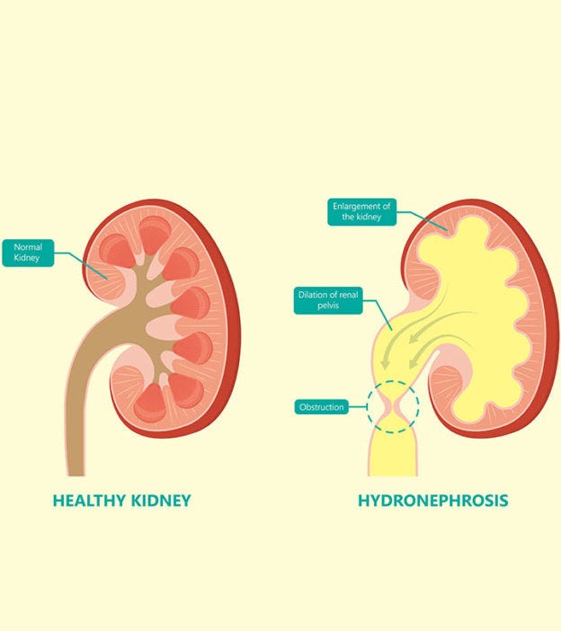 What are the symptoms of hydronephrosis? - Sankalphospitalvadodara - Medium