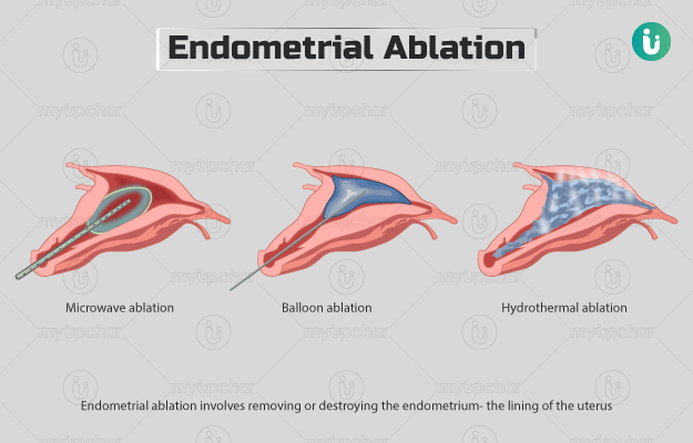 Endometrial Ablation: A Solution to Heavy Menstrual Bleeding | by Dr ...