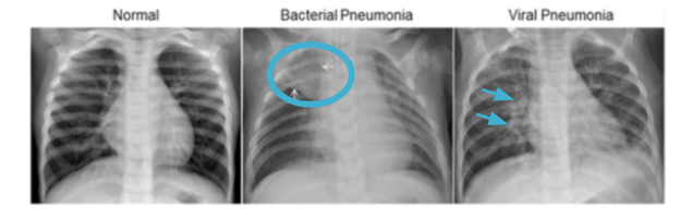 Computer Vision and Pneumonia Detection Part 1: Technical | by Erica ...
