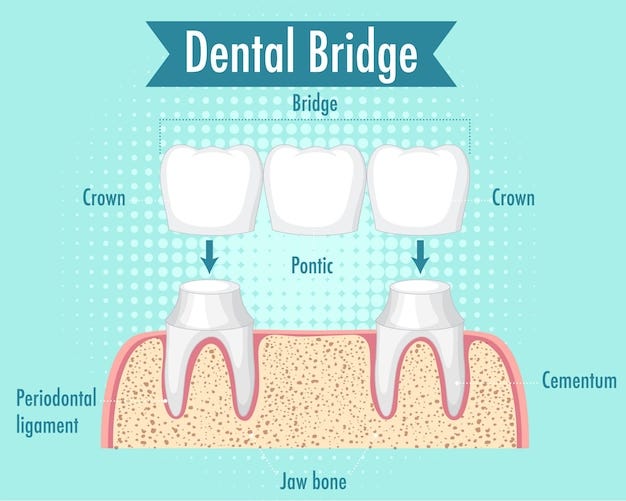Complete Guide to Dental Bridges: Understanding Types, Procedure, and ...