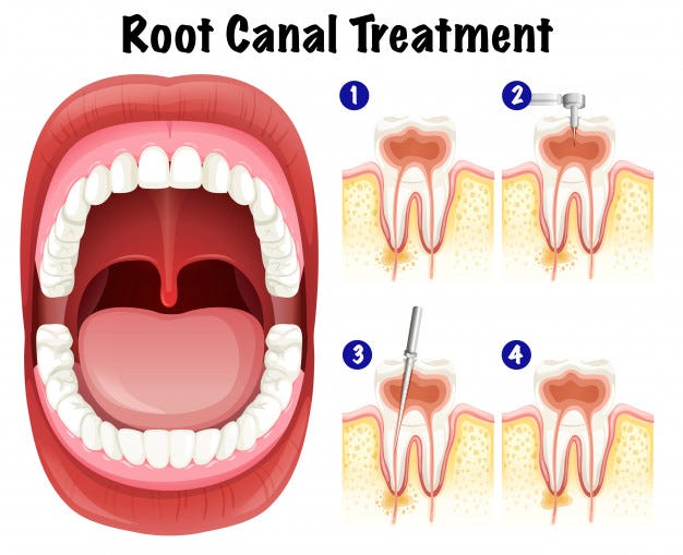 Root Canal Treatment and Its Procedure | by My Leaside Village Dental ...