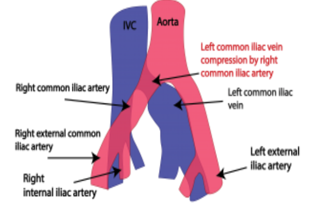 Compression Of Iliac Vein