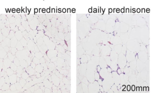 Obesity and Prednisone: Weekly Dose ‘Strikingly Different’ Outcomes vs ...
