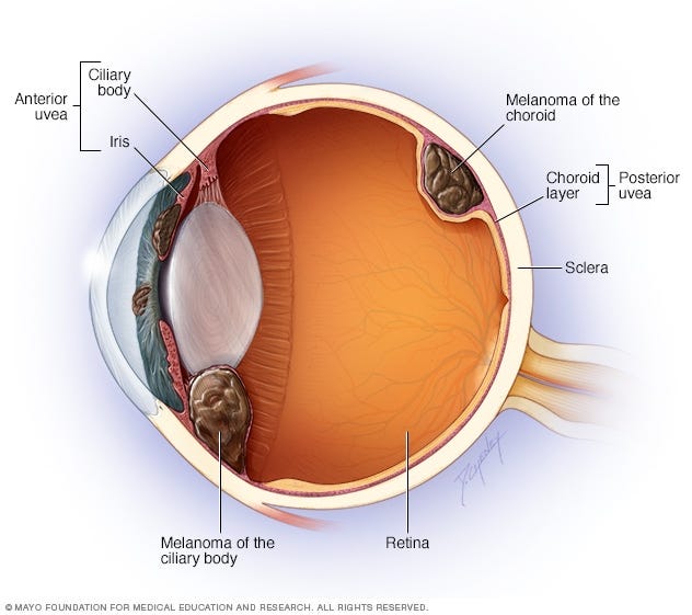Everything You Need to Know About Intraocular Melanoma | by Darshita ...