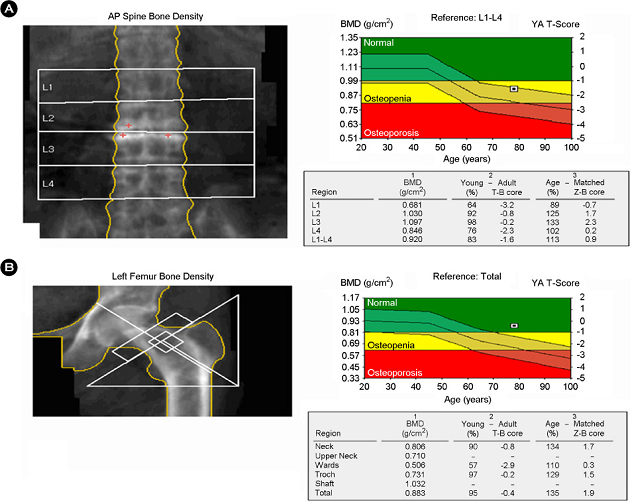 BMD- Bone Mineral Densitometry. CT Bone Mineral Densitometry / QCT /… | by ...