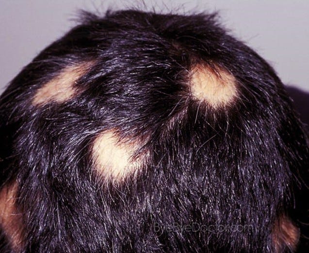 Alopecia What? Everything About Alopecia Areata! | by Amal Rafeeq | Medium