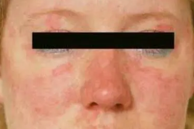 LUPUS is also known as Systemic Lupus Erythematosus (SLE). It is a chronic autoimmune disease ...