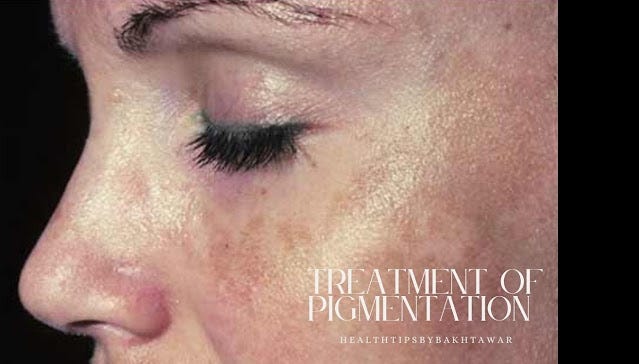 UNDERSTANDING AND TREATING PIGMENTATION: A COMPREHENSIVE GUIDE | by ...
