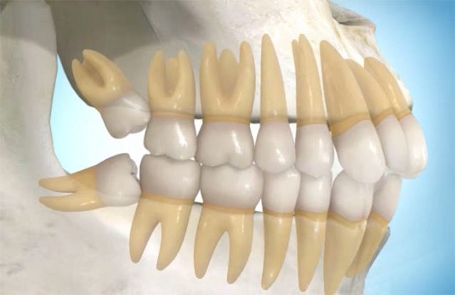 Things You Need To Know About Wisdom Teeth | by Darron Murrell | Medium