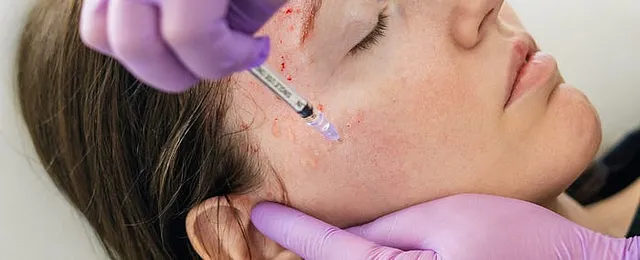 Vampire Facial Treatment: A Comprehensive Guide for Beginners | by ...