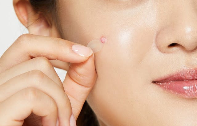 How Acne Patches Work: The Ultimate Skincare Hack | by Adnan | Aug ...