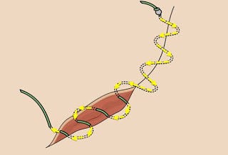 Subcuticular Suture Steps