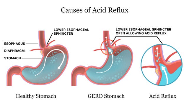 Acid Reflux - Bob Harvey - Medium