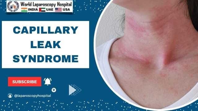 Capillary Leak Syndrome - laparoscopic hospital - Medium