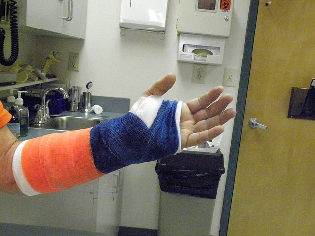 Cast Off. My left arm is enveloped in fiberglass… | by Alberto | Medium