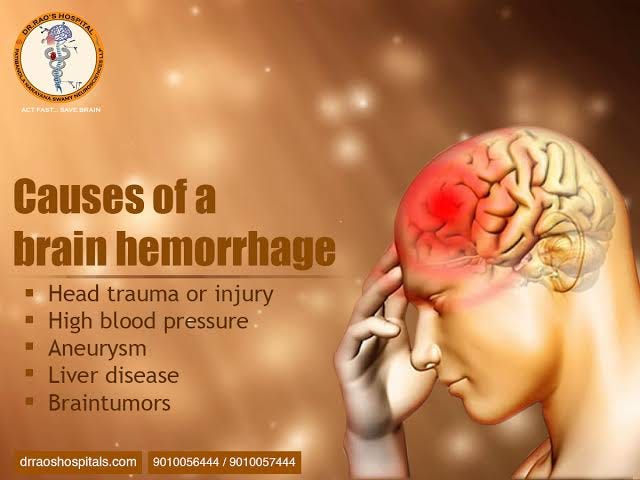 Brain Haemorrhage Symptoms, Causes and Treatment https://msgeniustools ...