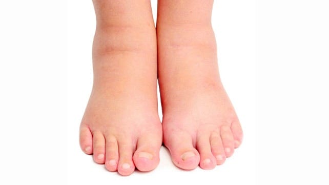 Cara Mengobati Edema Perifer Dengan Obat Edema Perifer | by Khasiat ...