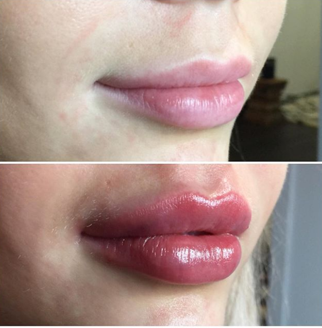 Lip Fillers in Reading. A small article about the frustrations… | by ...