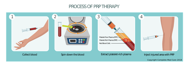 PRP Therapy Dallas — Complete Medcare | by Complete Medcare | Medium