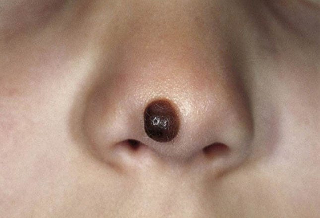 How Does One Pick A Suspicious Mole? | by skincancer clinic | Medium