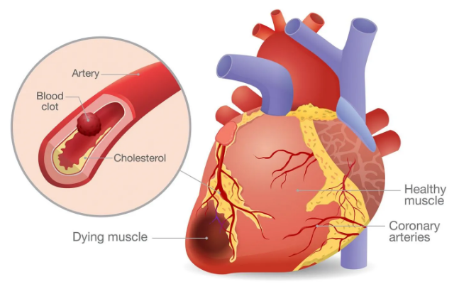 How Do You Manage a Sudden Heart Attack | by Accelerator | Medium