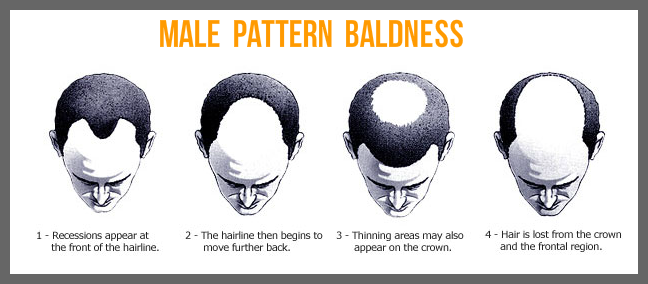 Why Male Pattern Baldness Is a Gender-Specific Phenomenon | by Mona ...