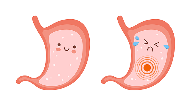 What is a Duodenal Ulcer? - Dr. Chintamani Godbole | Gastrointestinal ...