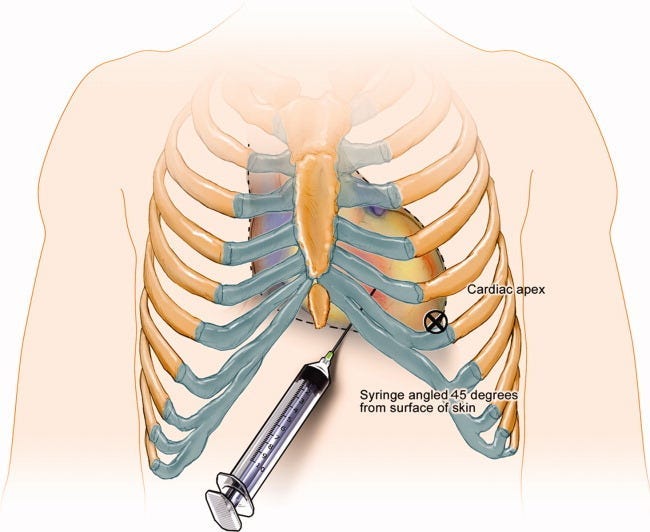 Pericardiocentesis. Pericardiocentesis is an invasive… | by Dem Ebs ...