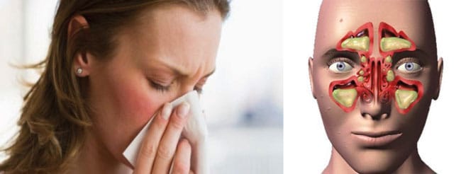 Open Surgery for Sinus Disease | Higgins-Sinus - higgins sinus - Medium