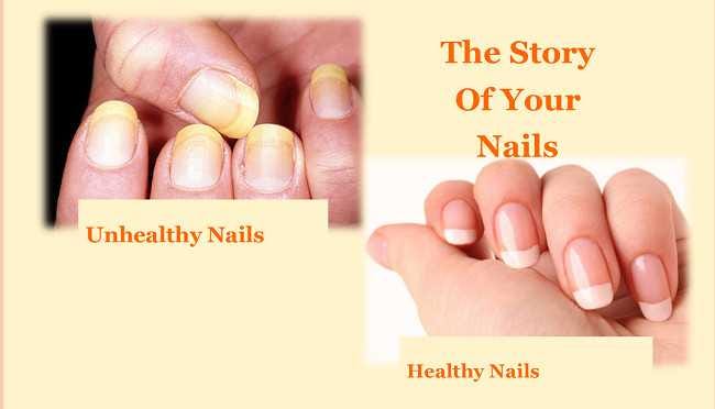 Healthy Nails Vs Unhealthy Nails