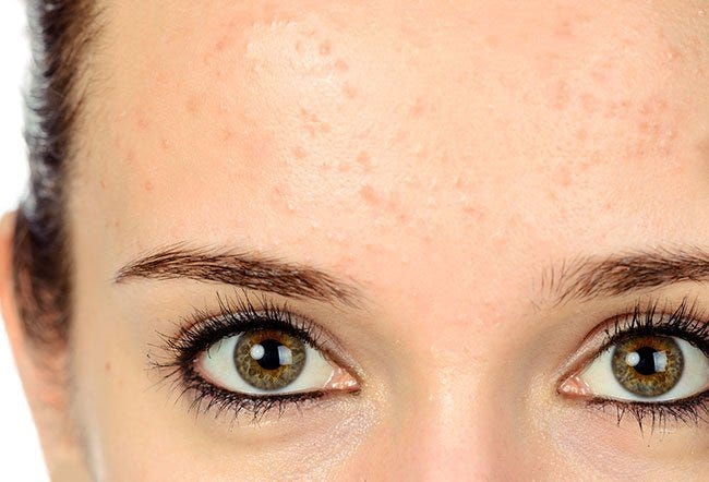 What That Acne Spot on Your Face Means, According to Science | by David ...
