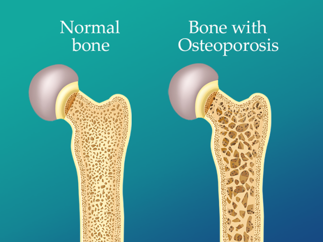 Understanding Osteoporosis: A Comprehensive Guide to Bone Health | by ...