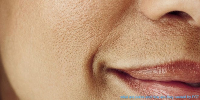 OPEN PORES TREATMENT. Open pores can be formed due to a… | by Gulshan ...