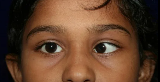 Innovations in Squint Eye Treatment | by Praveenamajety | Medium