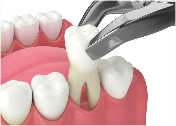 Exploring the Pros and Cons: Tooth Extraction vs. Root Canal Treatment ...